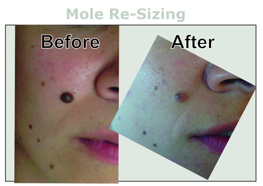 mole resizing | InSkin