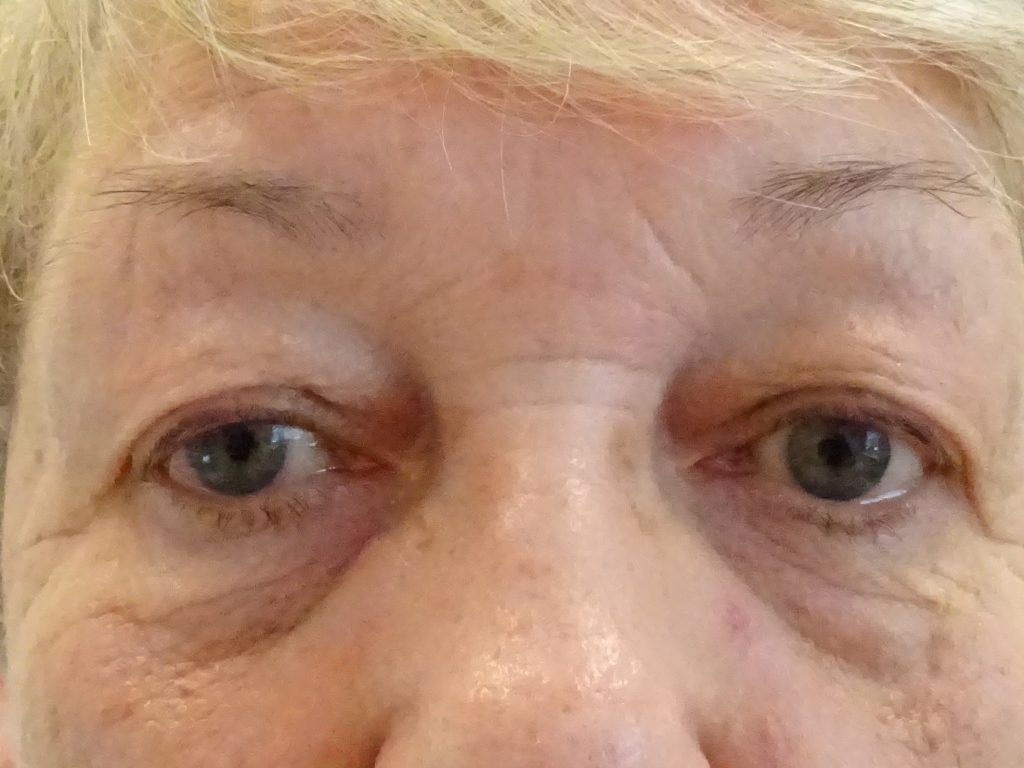 upper after treatment | InSkin