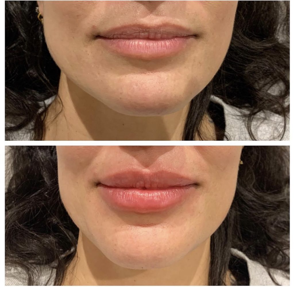 Lip Fillers | InSkin